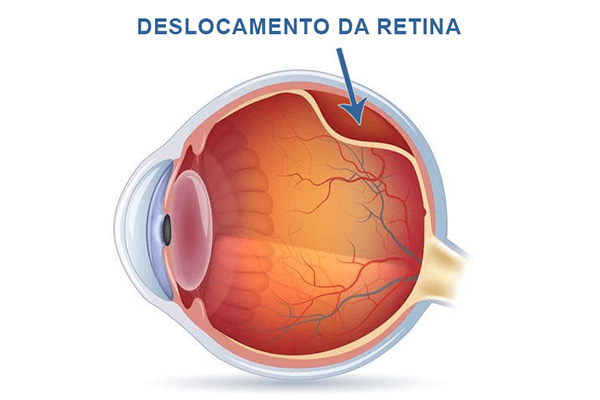 Doença da Retina - IOP - Instituto Oftalmológico Paulista